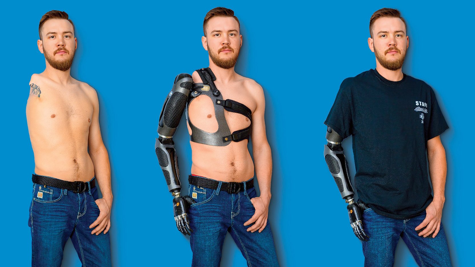Harnesses and Upper Limb Prostheses